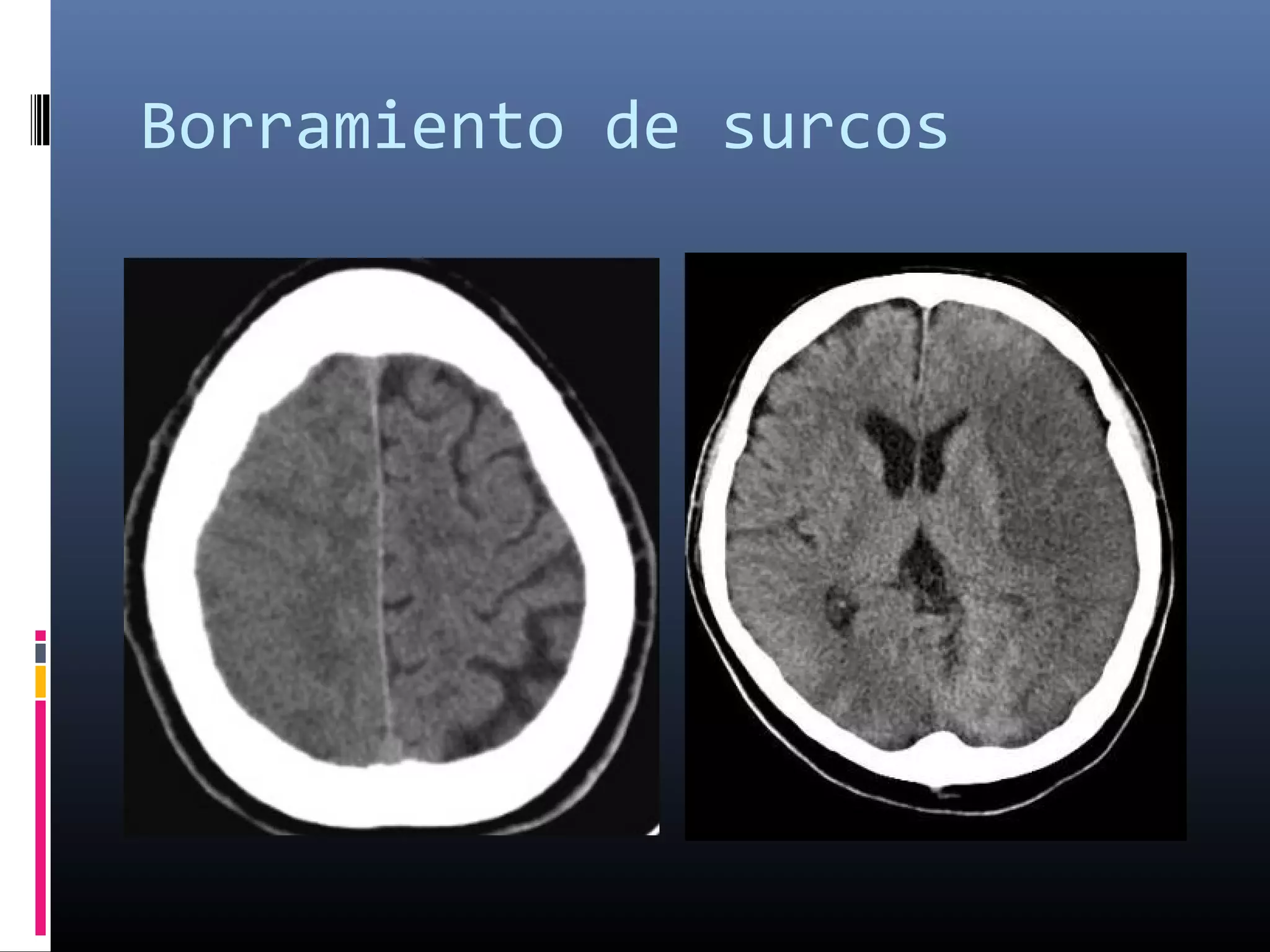 Accidente Cerebrovascular isquemico | PPT