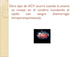 Acv hemorragico | PPT