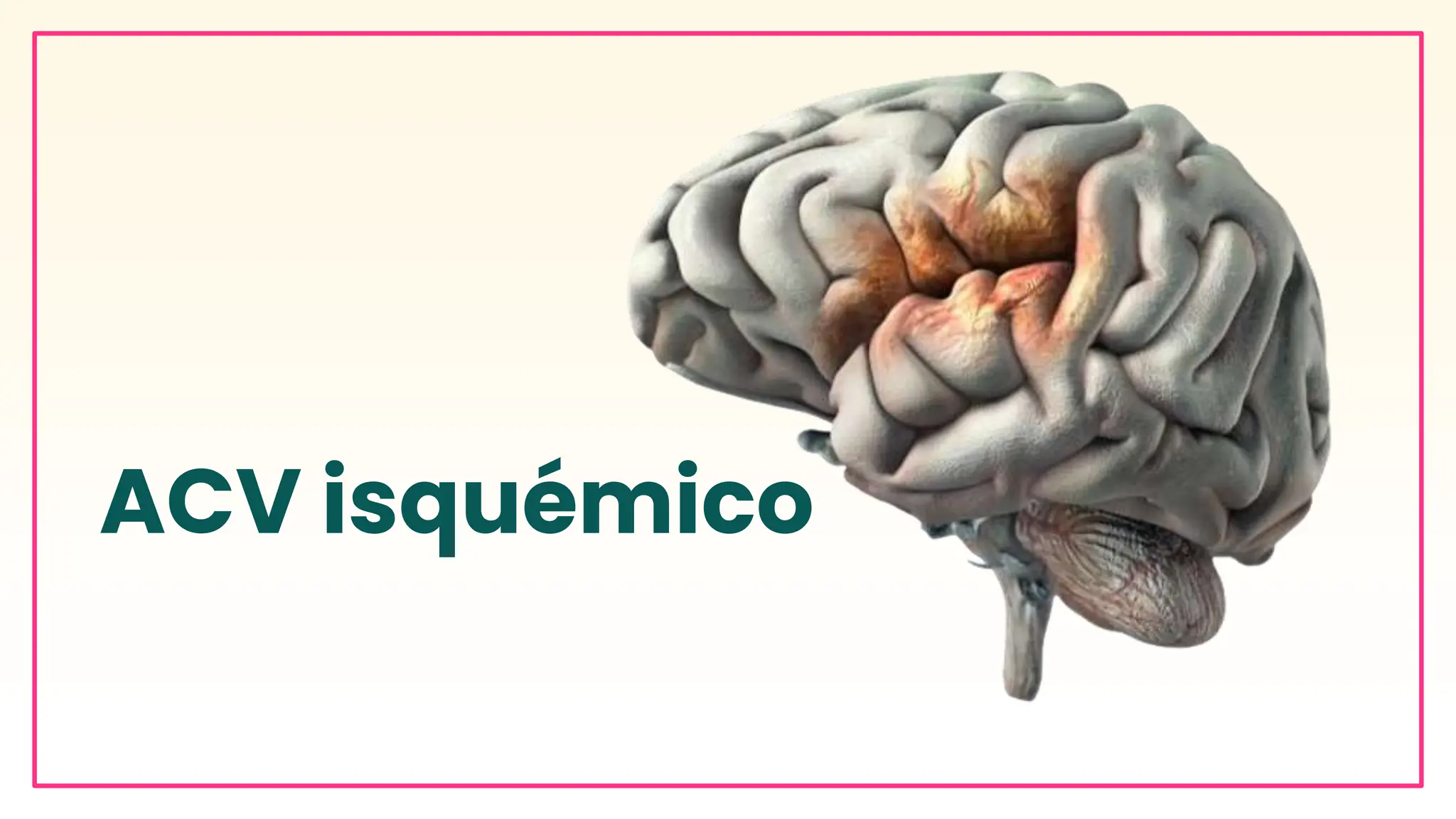 Accidente Cerebro Vascular Isquemico (ACV).pptx