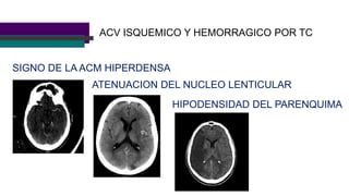 ACV isquemico y hemorragico.pptx