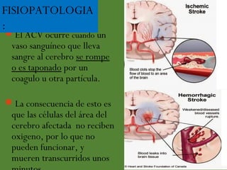 ACV | PPT