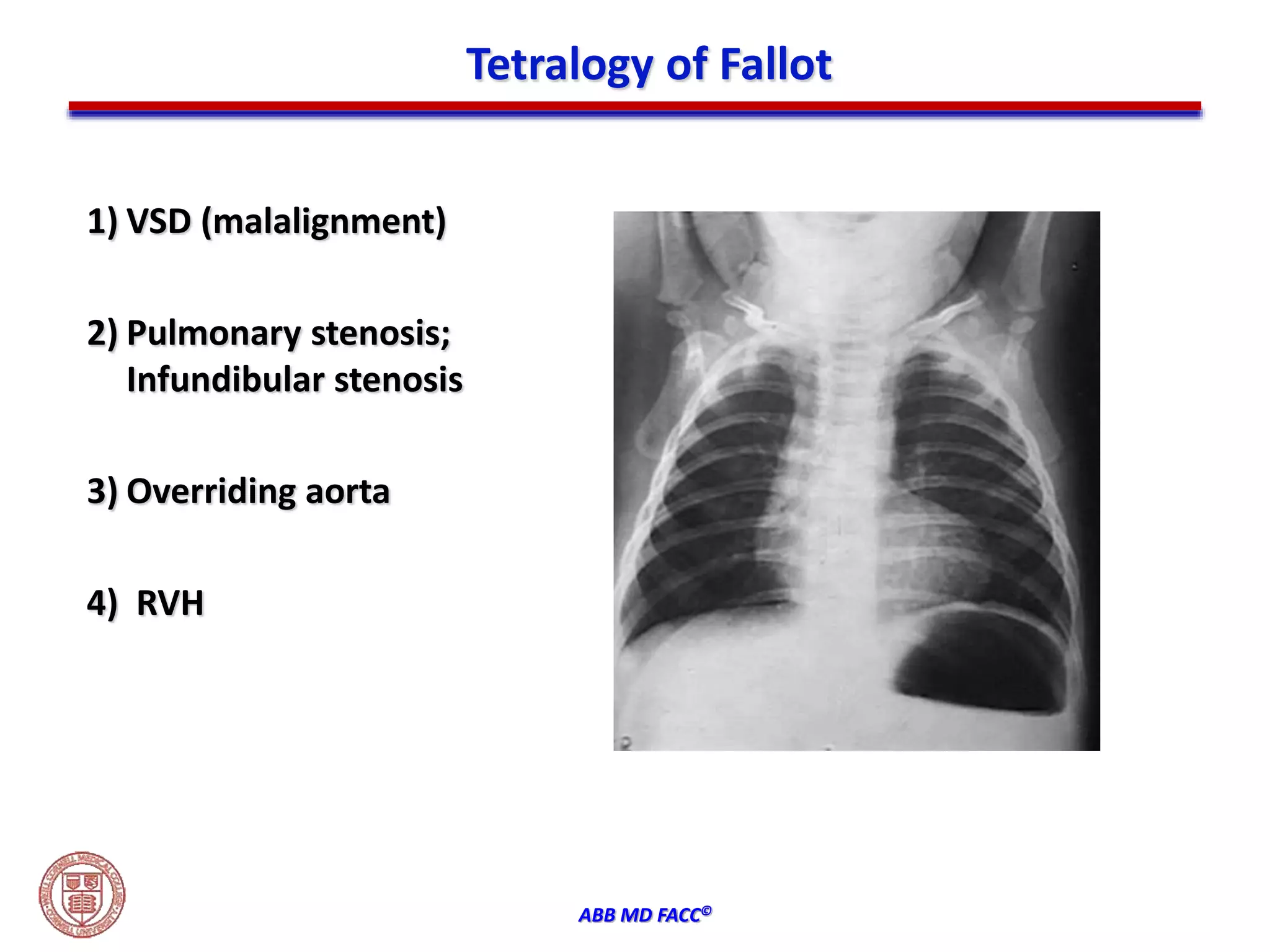 Acyanotic and cyanotic shunt lesions 03 2019 | PPT
