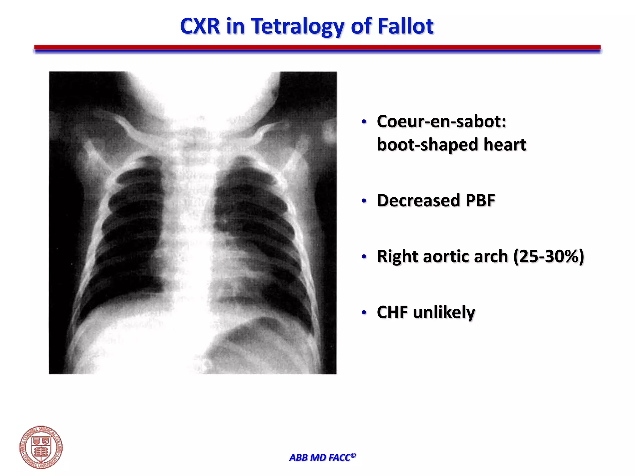 Acyanotic and cyanotic shunt lesions 03 2019 | PPT