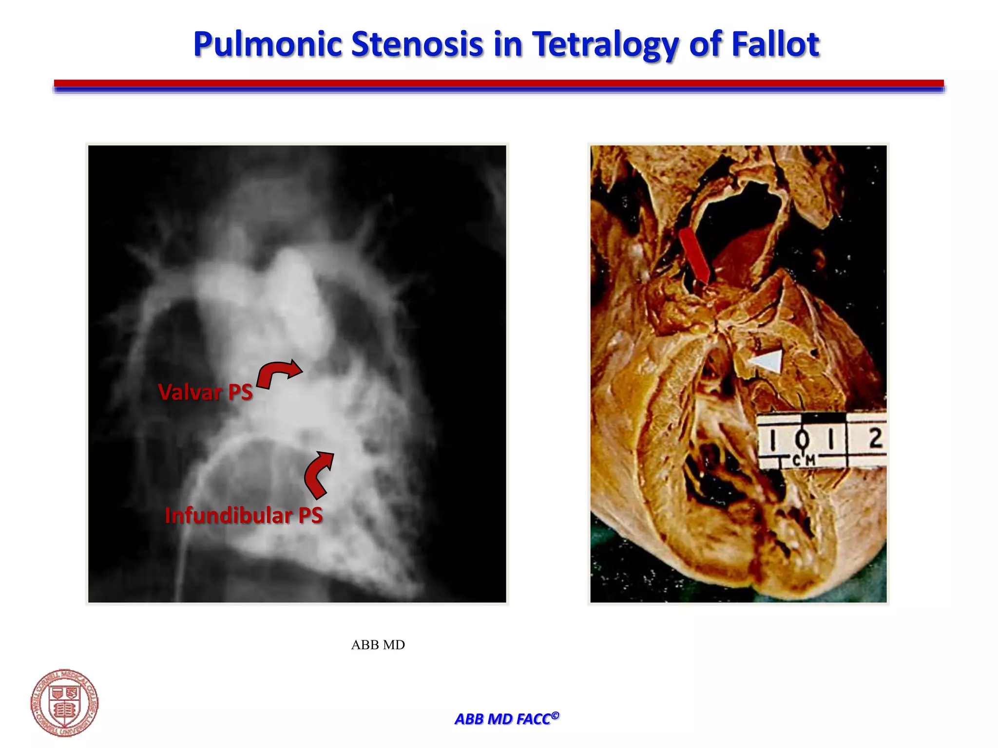 Acyanotic and cyanotic shunt lesions 03 2019 | PPT