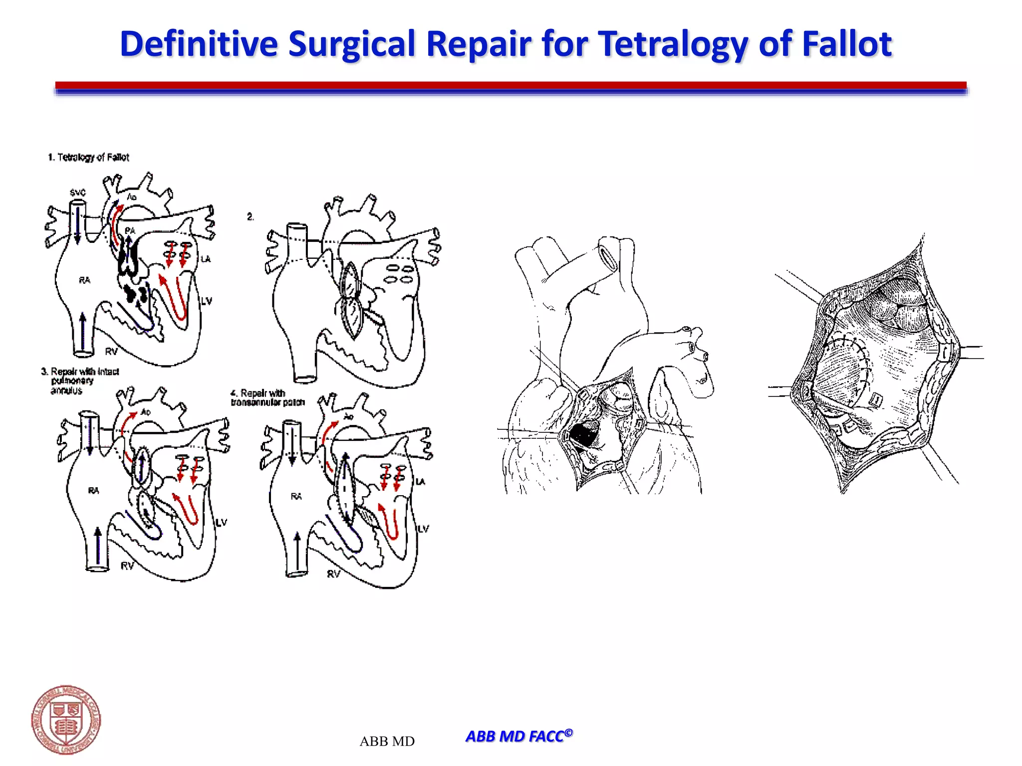 Acyanotic and cyanotic shunt lesions 03 2019 | PPT