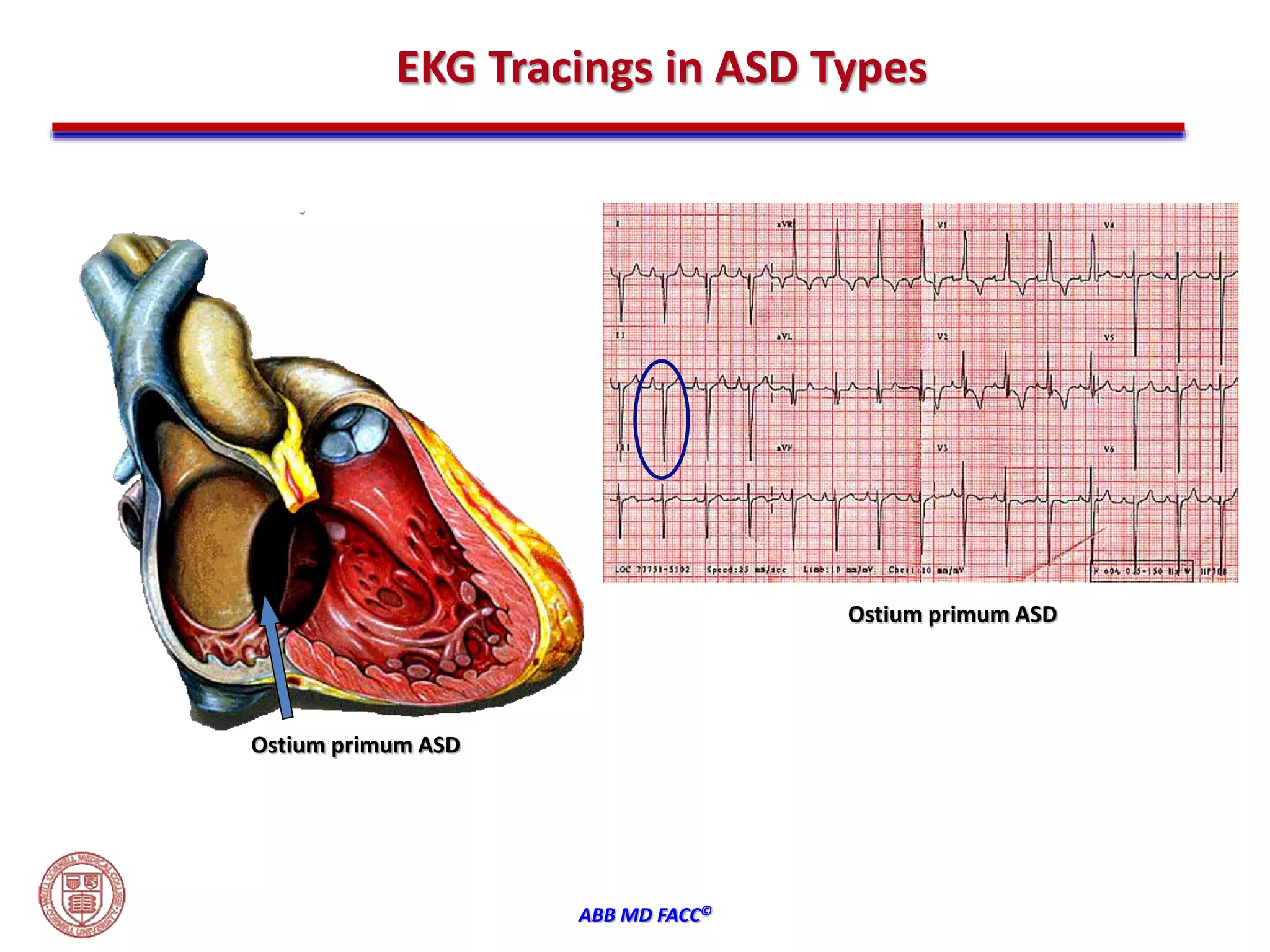 Acyanotic and cyanotic shunt lesions 03 2019 | PPT
