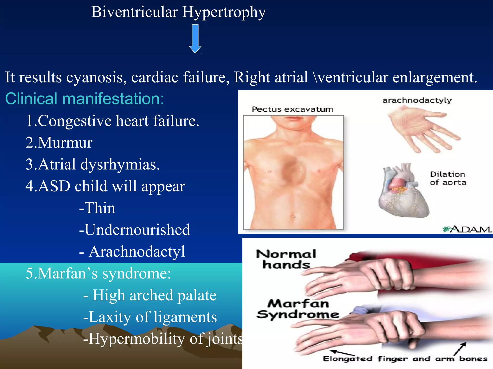 Acyanotic heart diseases | PPT
