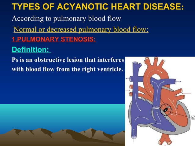 Acyanotic heart diseases | PPT