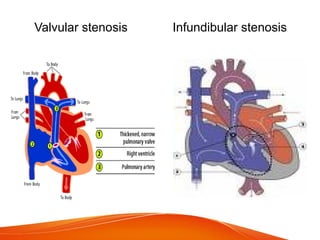acyanoticheartdiseases- tof coa pulmonic | PPT