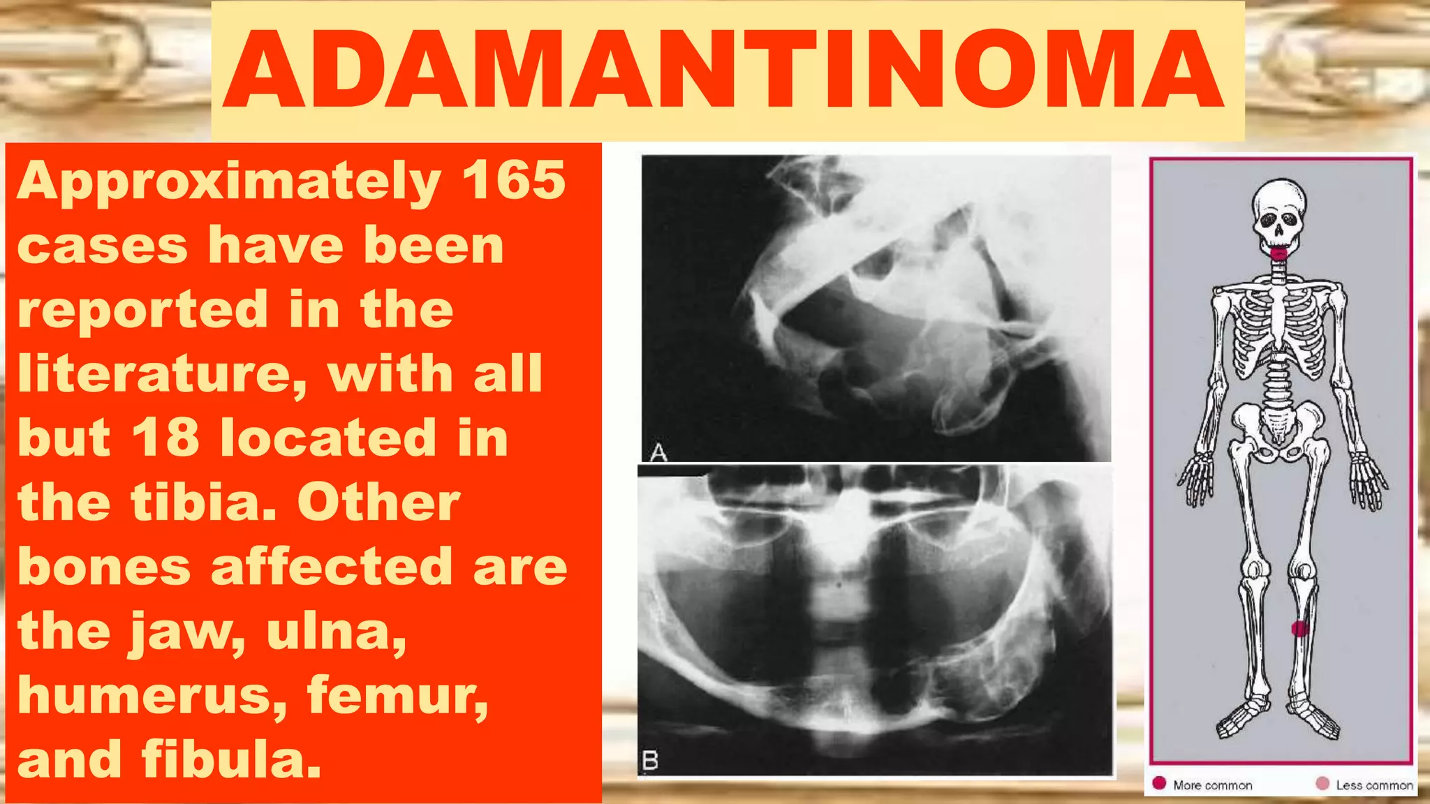 Adamantinoma 1 | PPTX