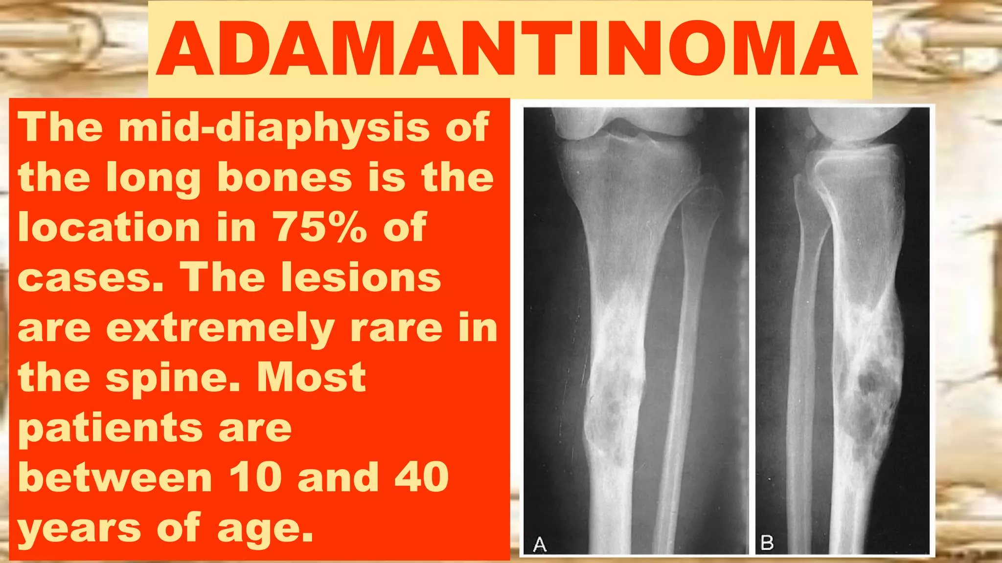 Adamantinoma 1 | PPTX