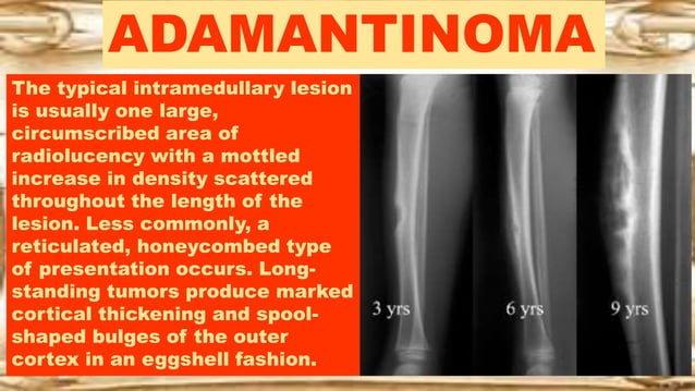 Adamantinoma 1 | PPTX