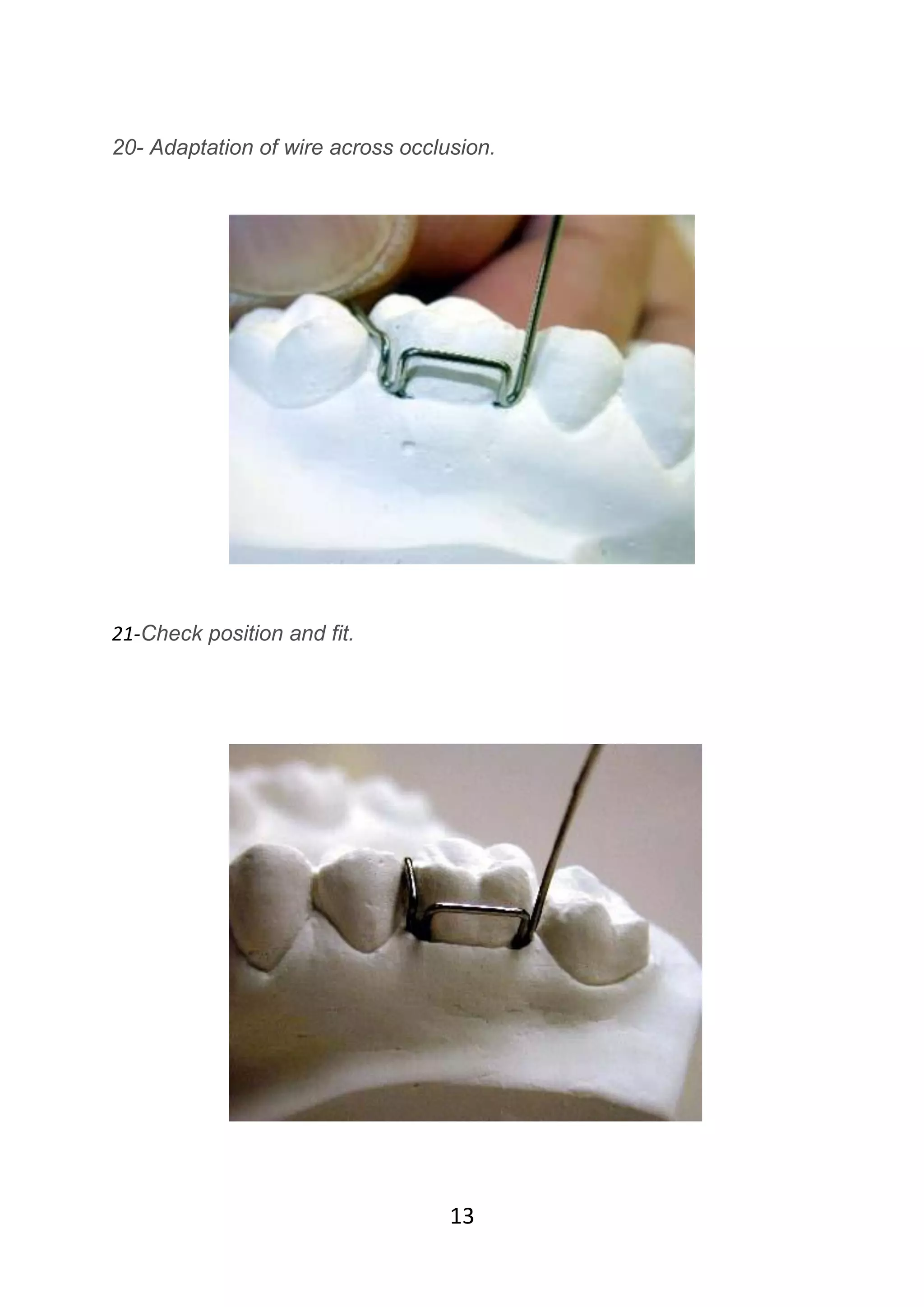Adams clasp practice | PDF