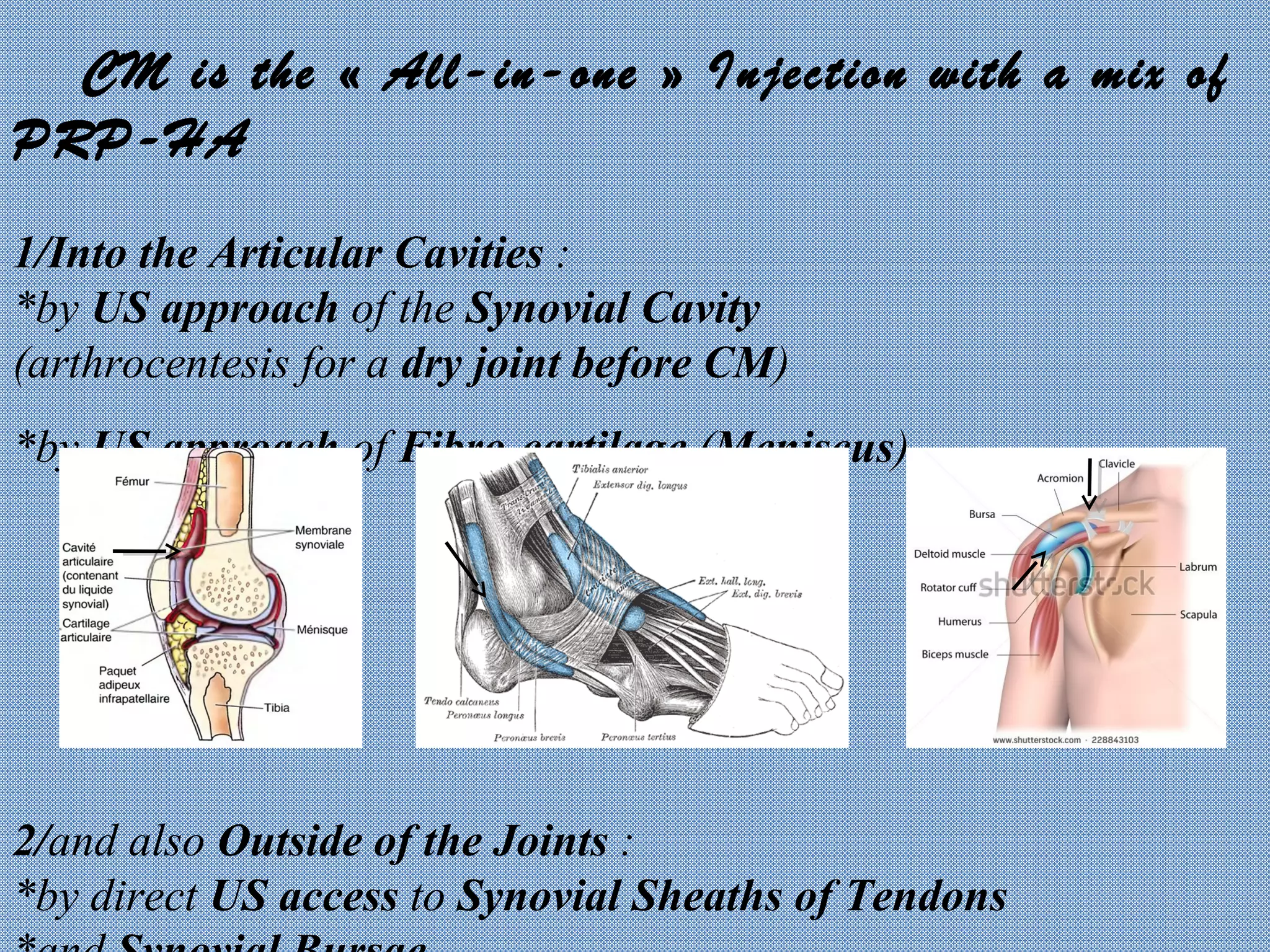Use of PRP-HA for the treatment of Articular and Periarticular diseases ...