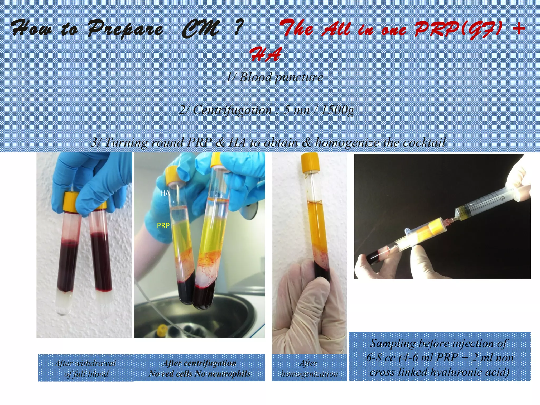 Use of PRP-HA for the treatment of Articular and Periarticular diseases ...