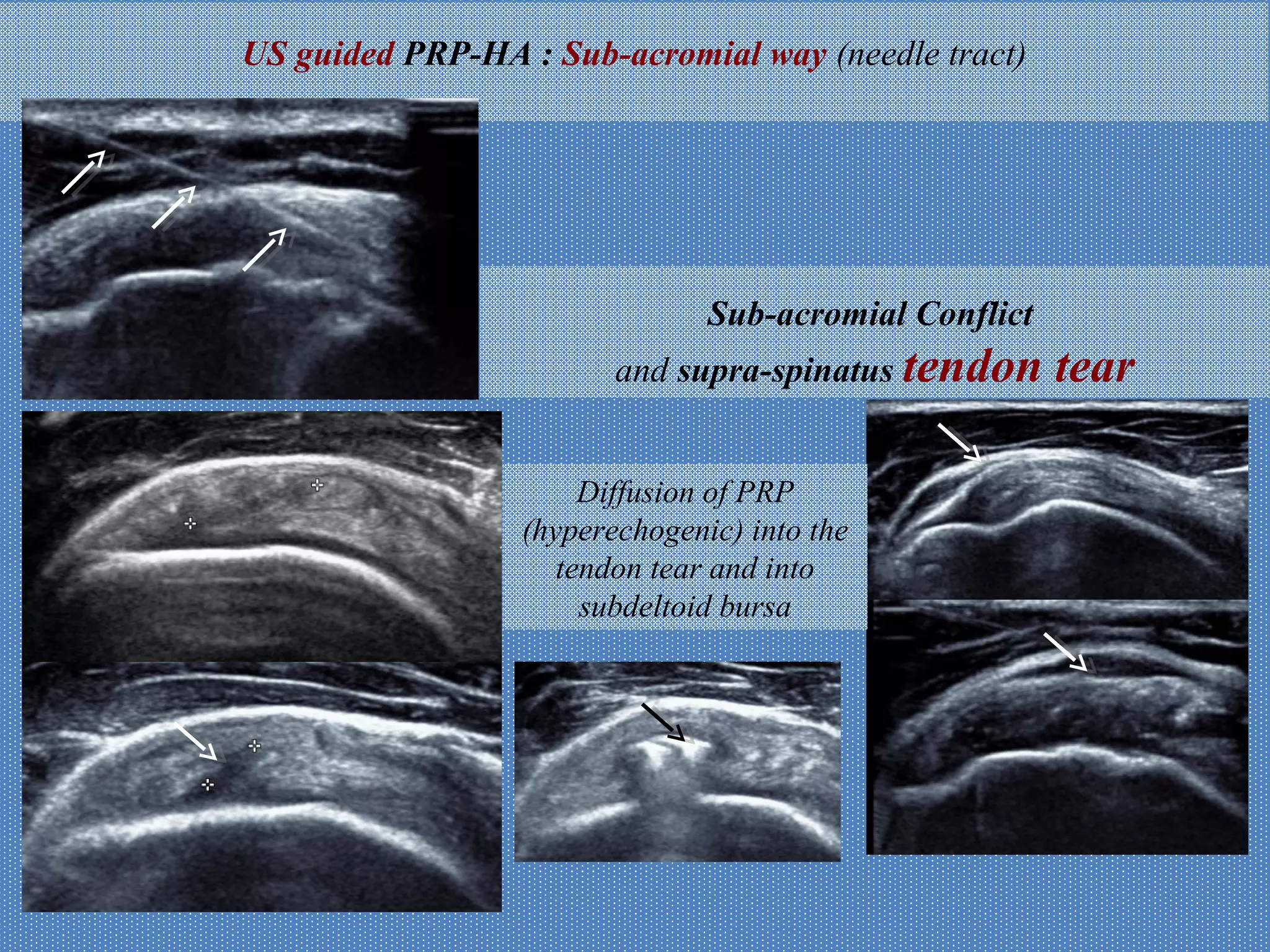 Use of PRP-HA for the treatment of Articular and Periarticular diseases ...