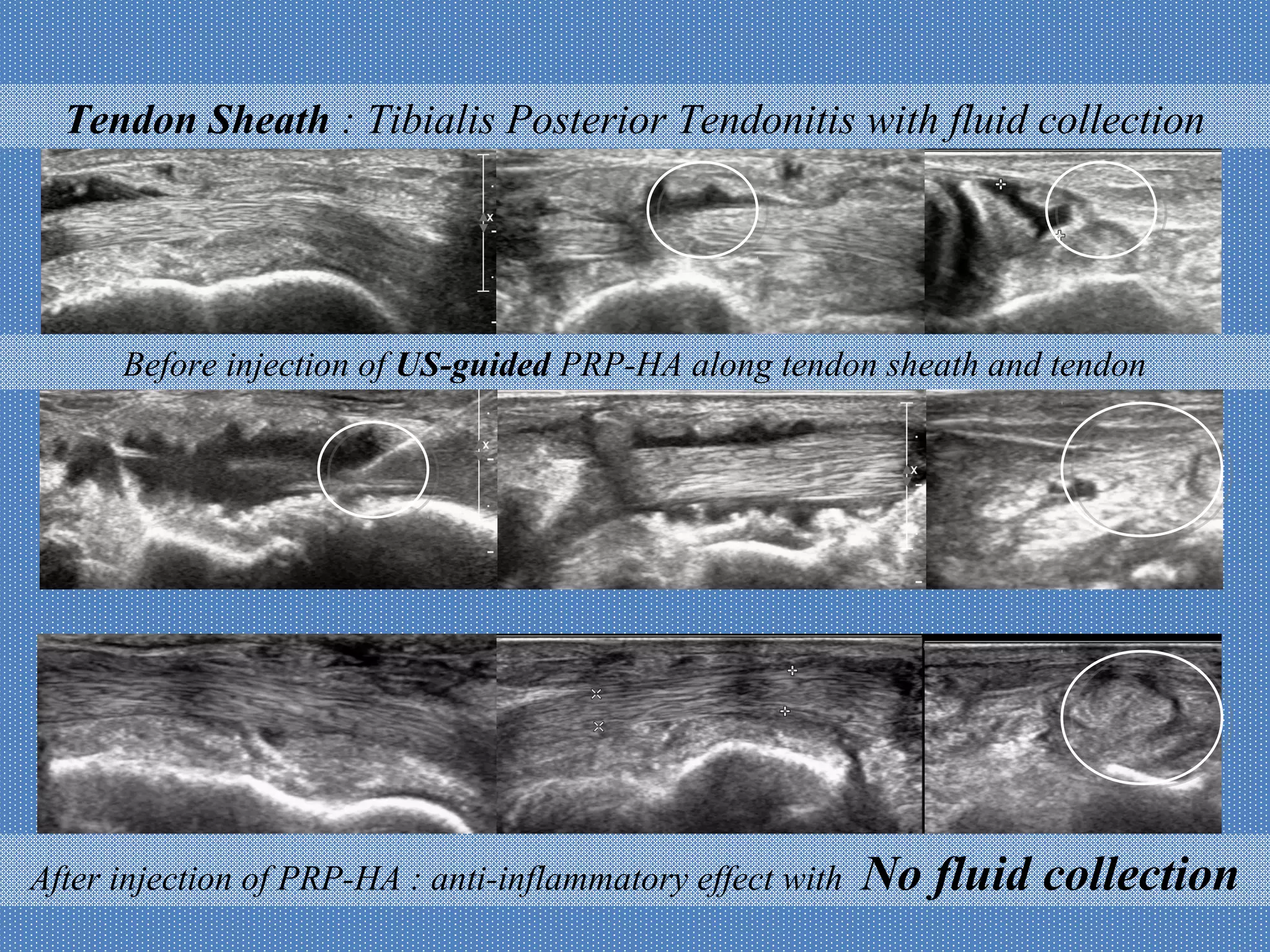 Use of PRP-HA for the treatment of Articular and Periarticular diseases ...
