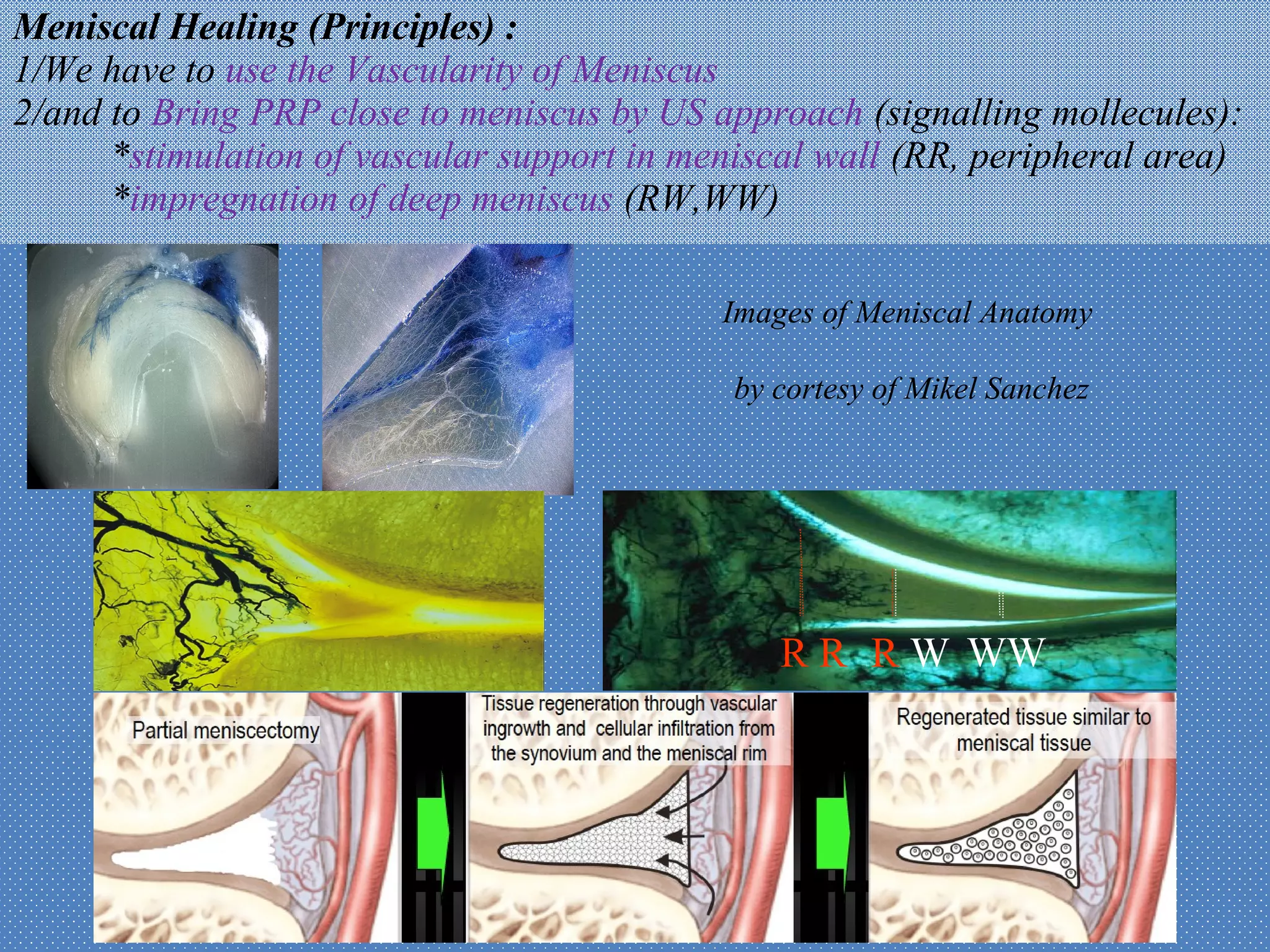 Use of PRP-HA for the treatment of Articular and Periarticular diseases ...