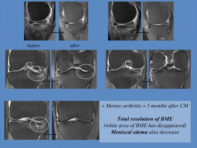 Use of PRP-HA for the treatment of Articular and Periarticular diseases ...
