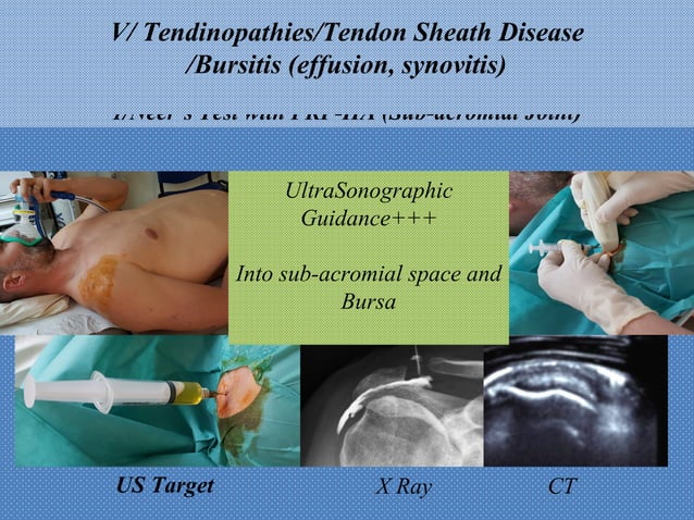 Use of PRP-HA for the treatment of Articular and Periarticular diseases ...