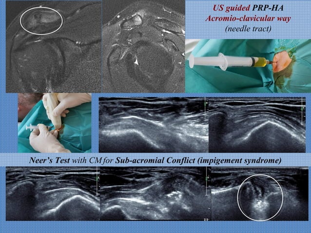 Use of PRP-HA for the treatment of Articular and Periarticular diseases ...