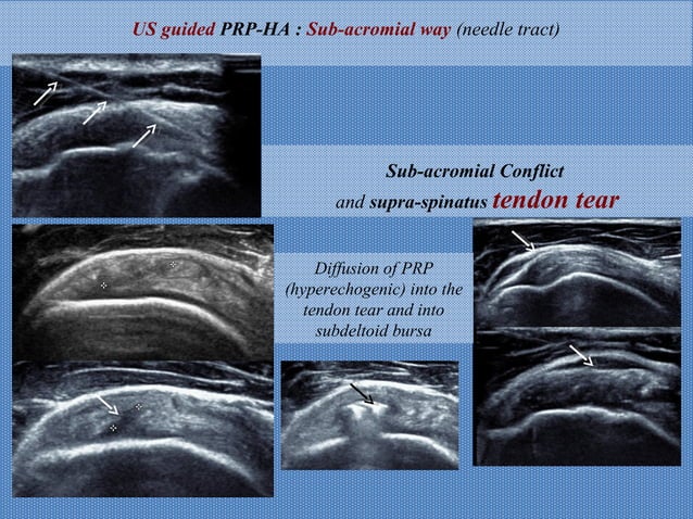 Use of PRP-HA for the treatment of Articular and Periarticular diseases ...