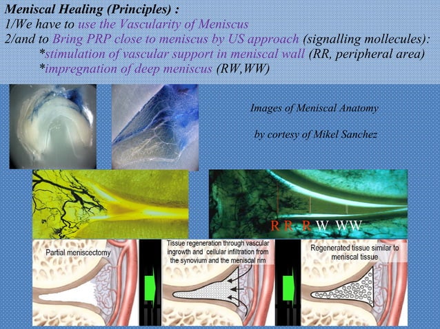 Use of PRP-HA for the treatment of Articular and Periarticular diseases ...