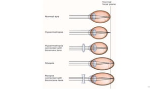 Adaptation,Color vision & Errors of Refraction | PPSX