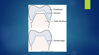 ADA Seal of Acceptance - Dental Cements- Key Terms, Uses | PPTX