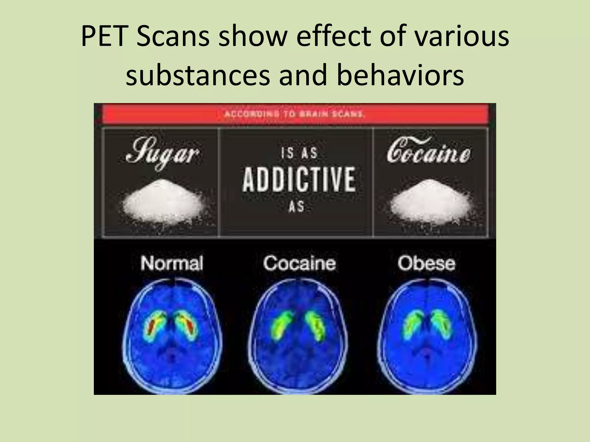 Addiction Is A Brain Disease | PPTX