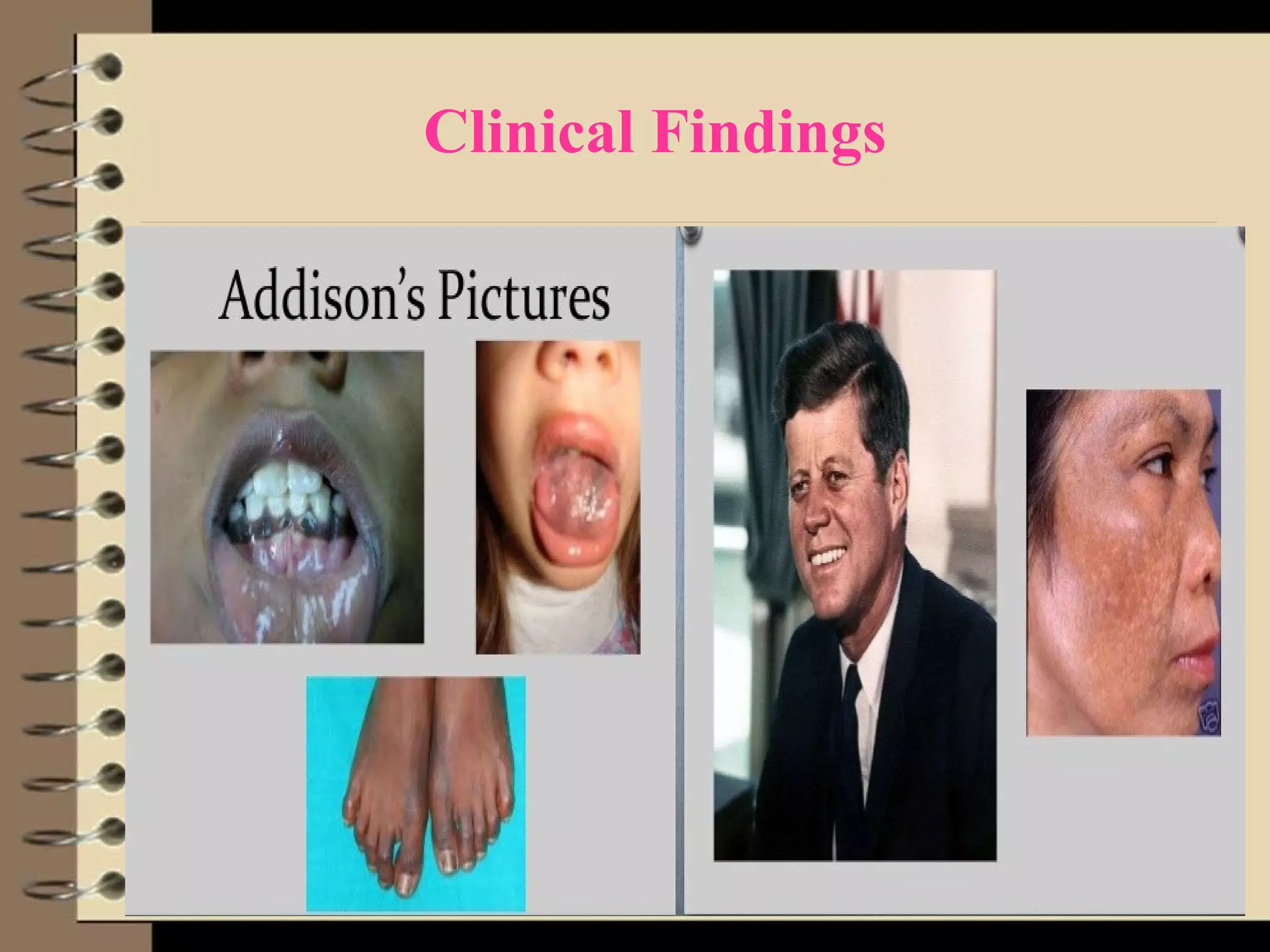 Addison's Disease powerpoint | PPT