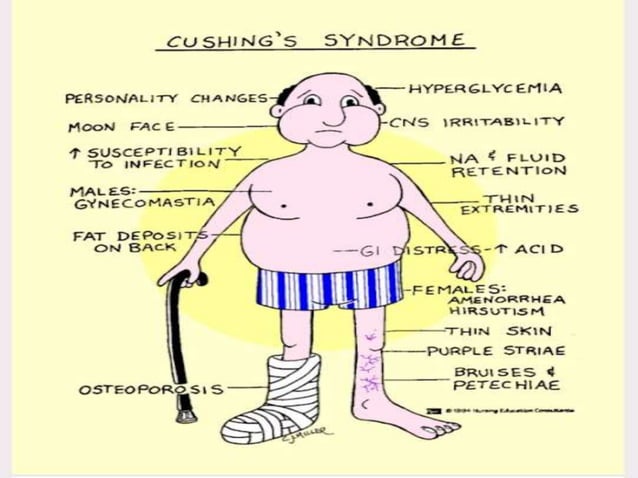 Addison and cushing syndrome and its management | PPTX