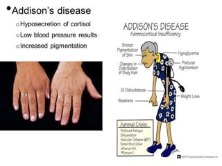 Addison and cushing syndrome and its management | PPTX