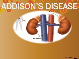 addison disease adults and its management.ppt