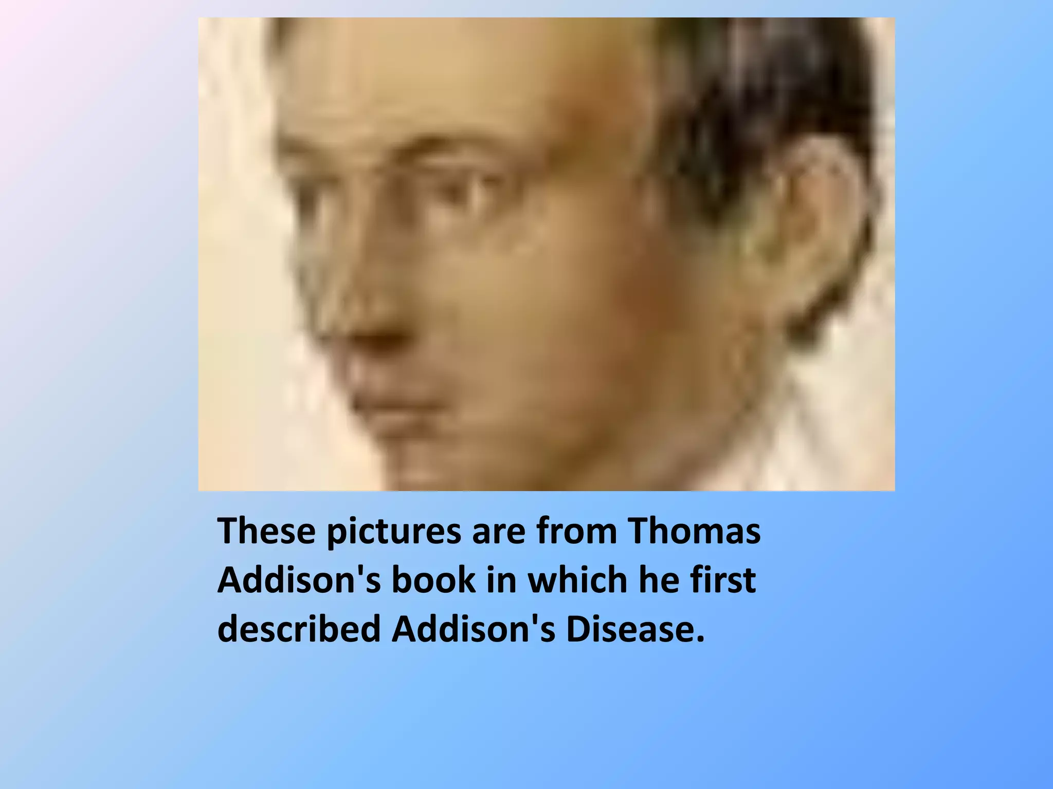 Addison disease by dr shahjada selim | PPTX