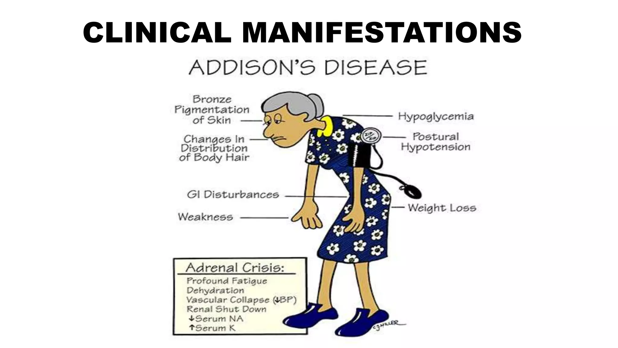 Addisons disease and its management | PPTX