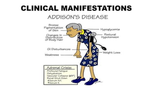 Addisons disease and its management | PPTX