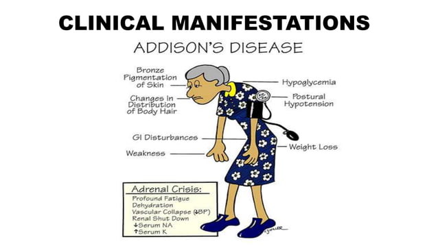 Addisons disease and its management | PPTX | Hormonal Disorders ...