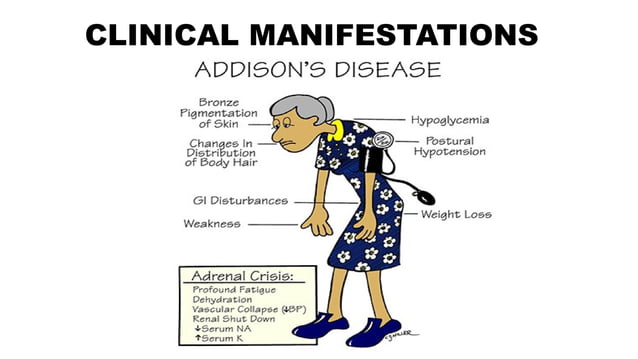 addisons disease, it's pathogenesis and management | PPT