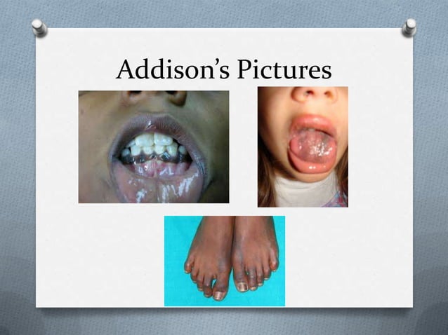 Addison’s disease final ppt | PPT