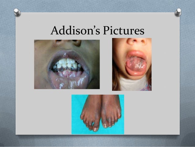 Addison’s disease final ppt