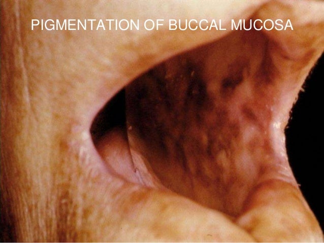 Addison’s disease important DR. Aijin.A.Mohan