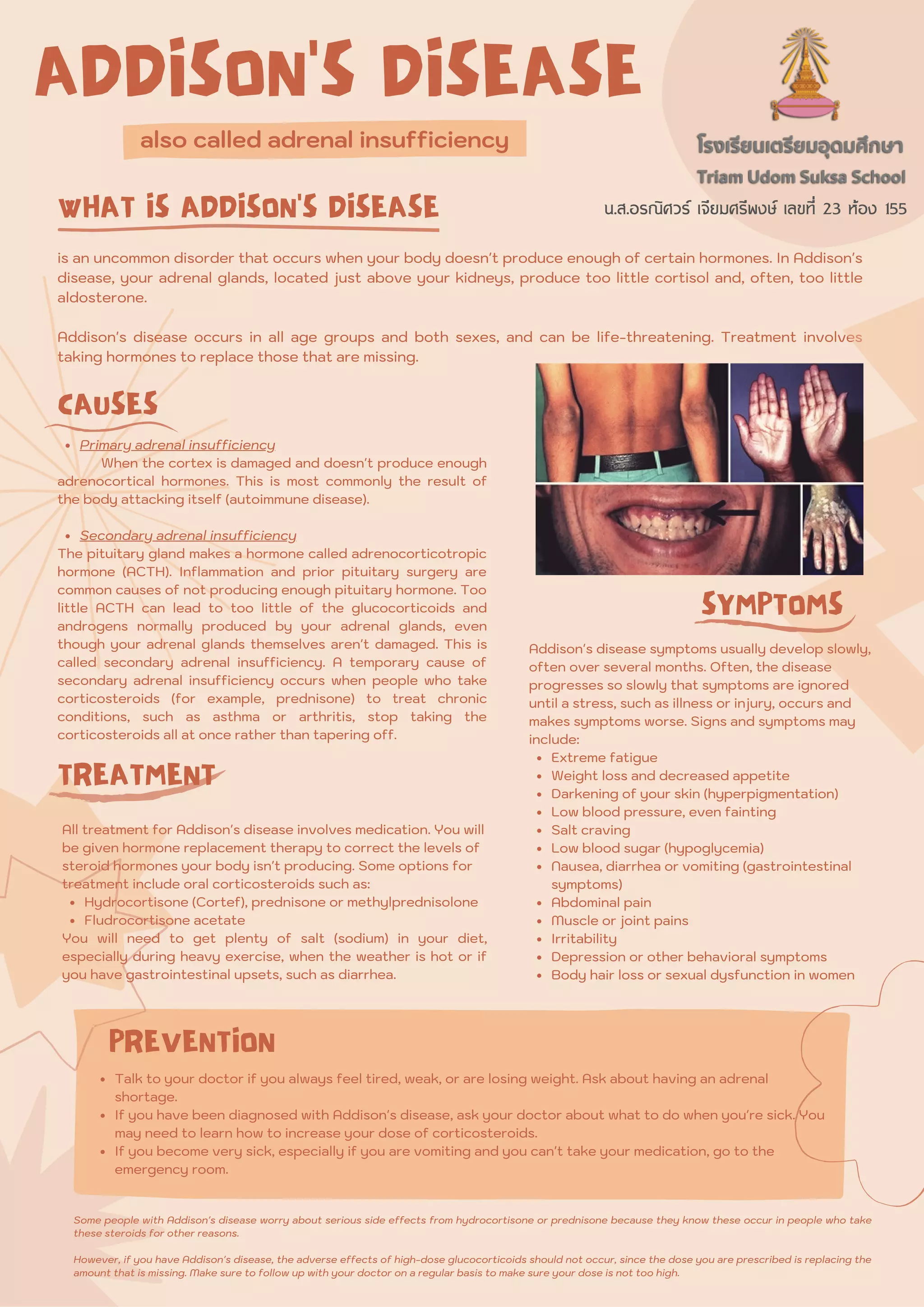 Addison's disease | PDF