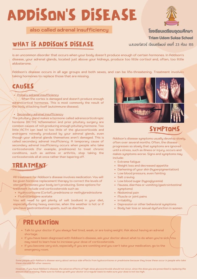 Addison's disease | PDF