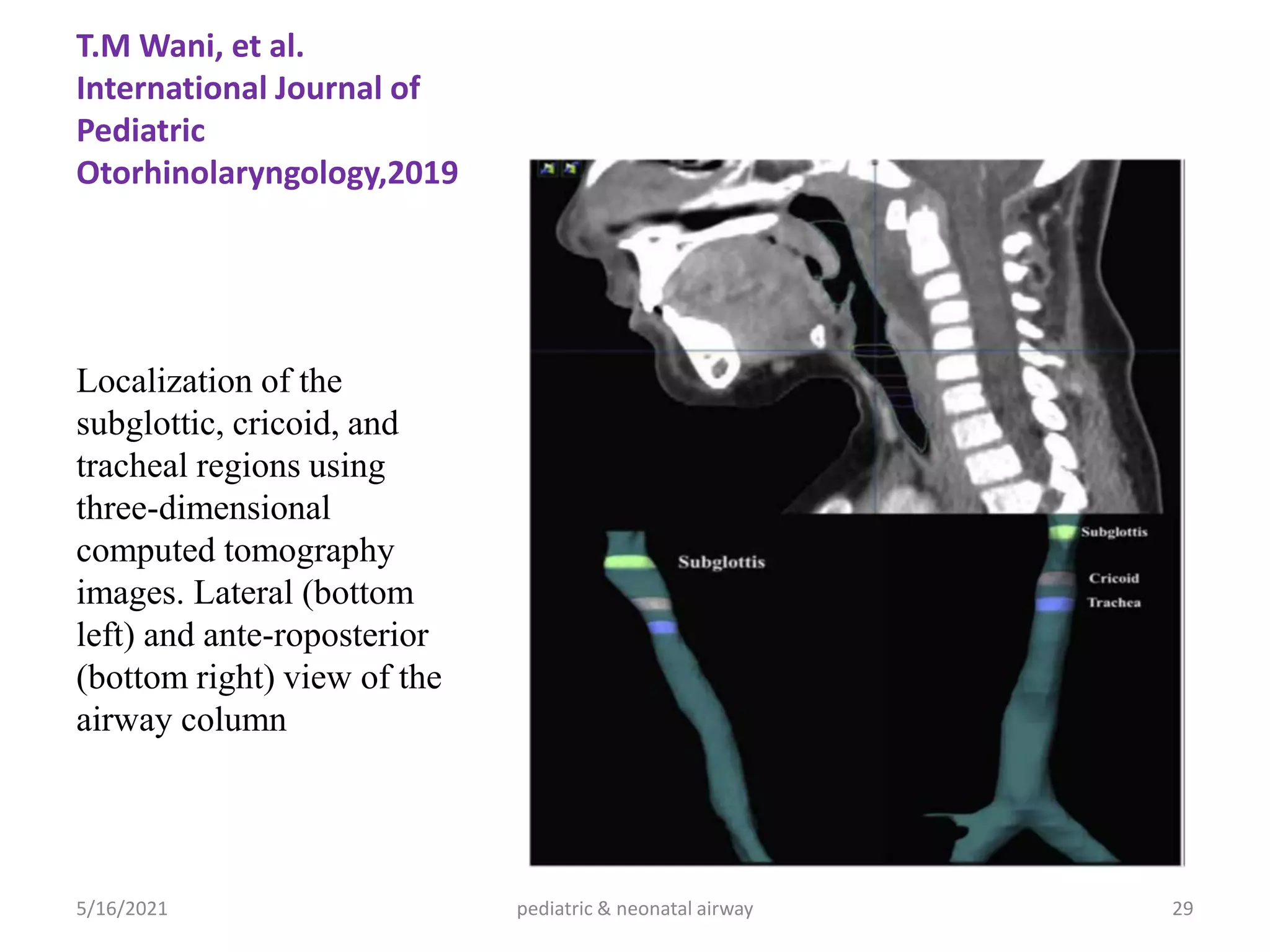 pediatrics airway anatomy | PPTX