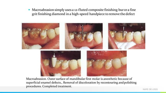 Additional conservative esthetic procedures by dr.maryam salman | PPTX ...