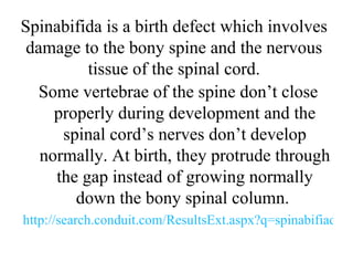 Child with Spina bifida | PPT