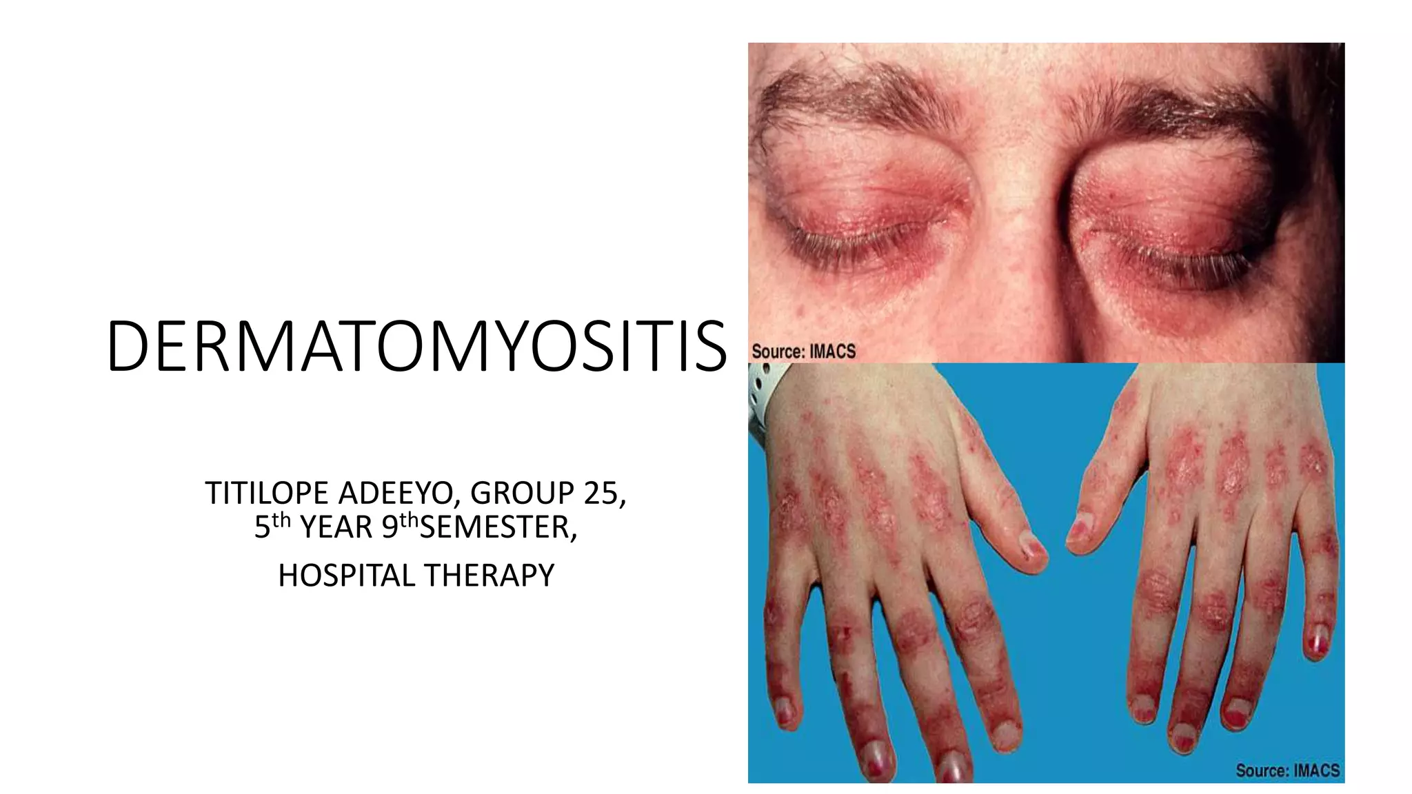Dermatomyositis PPT | PPTX
