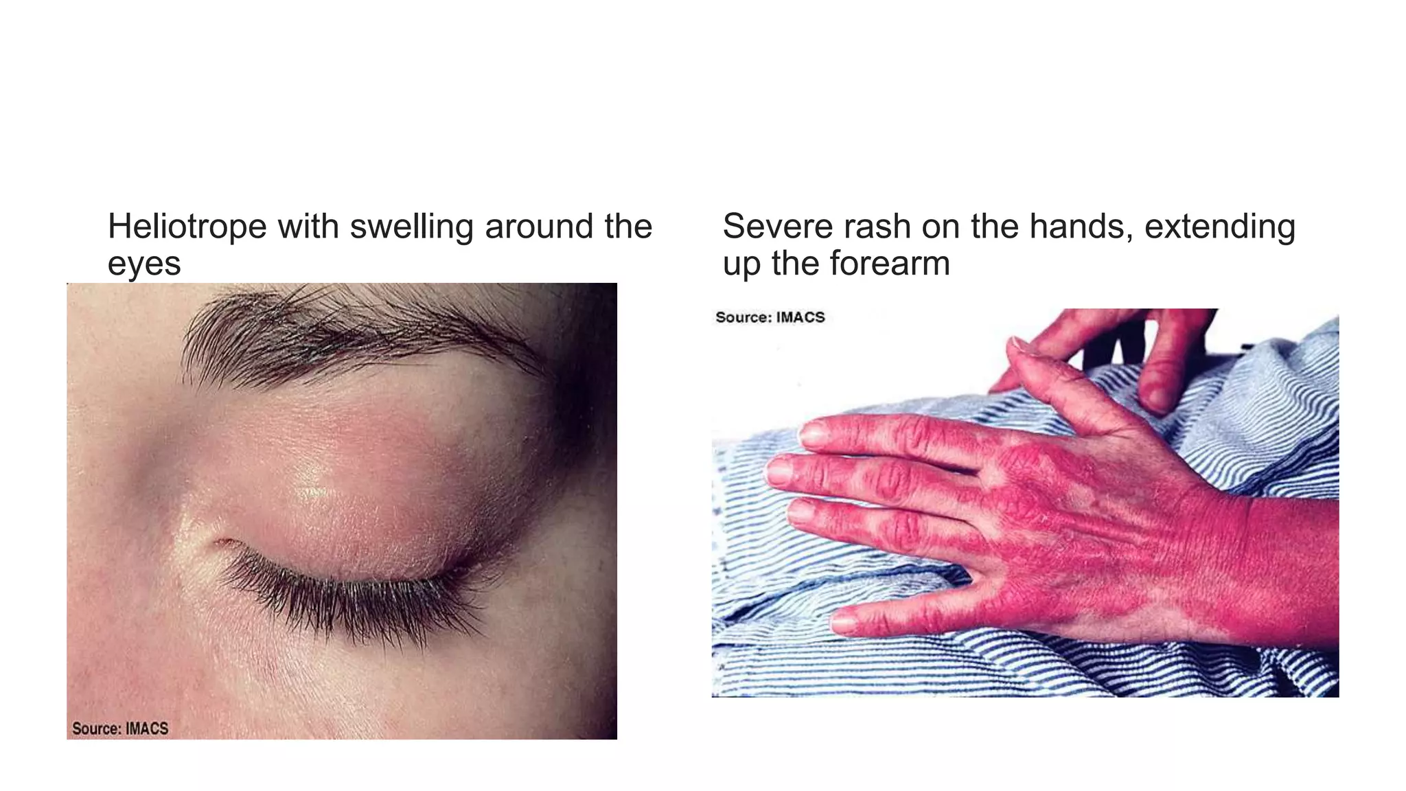 Dermatomyositis PPT | PPTX