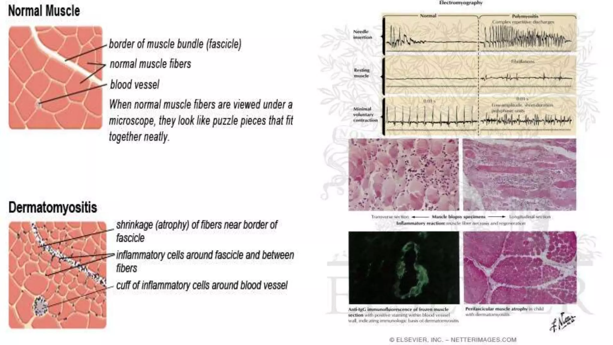 Dermatomyositis PPT | PPTX